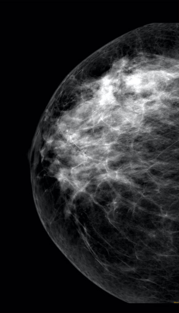 Clarity - Smart Breast™