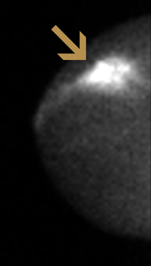 Clarity - Smart Breast™