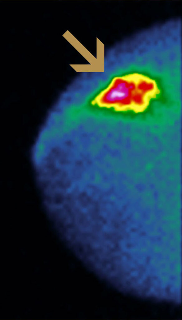 Clarity - Smart Breast™