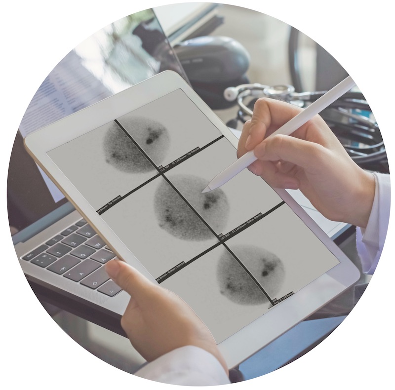 Smart Breast™ - Molecular Breast Imaging Technology