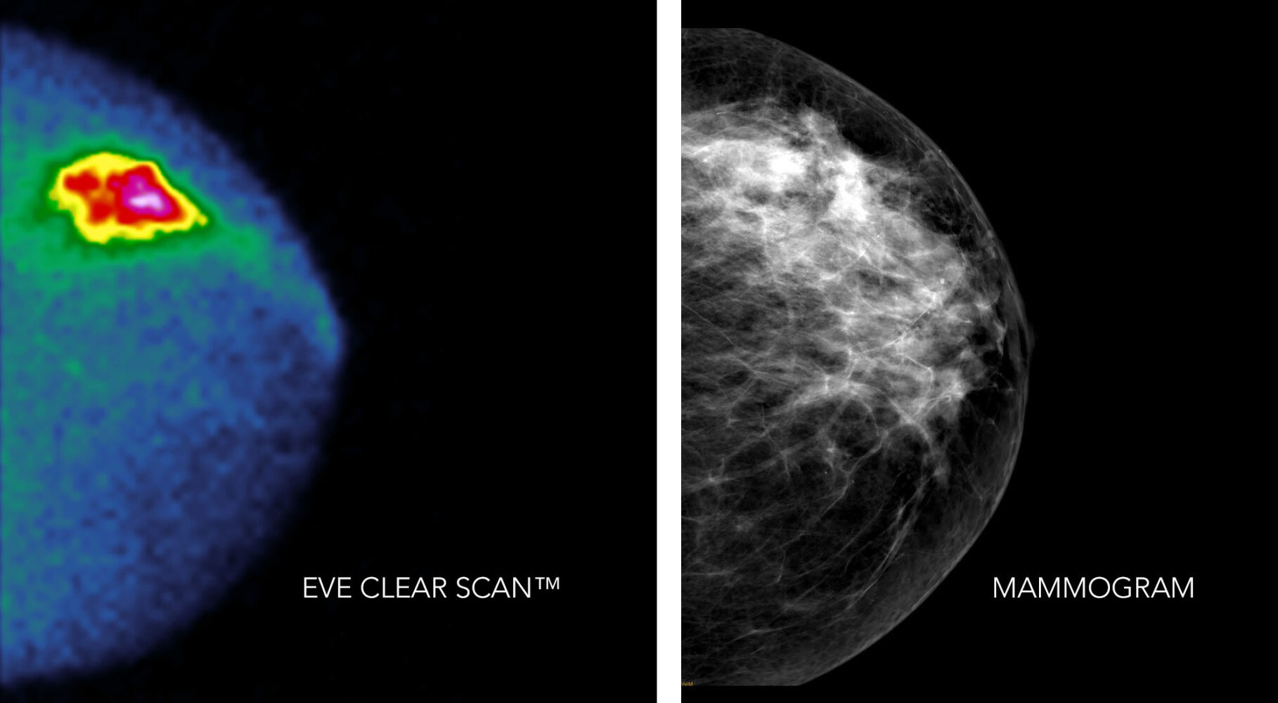 Smart Breast™ - Molecular Breast Imaging Technology